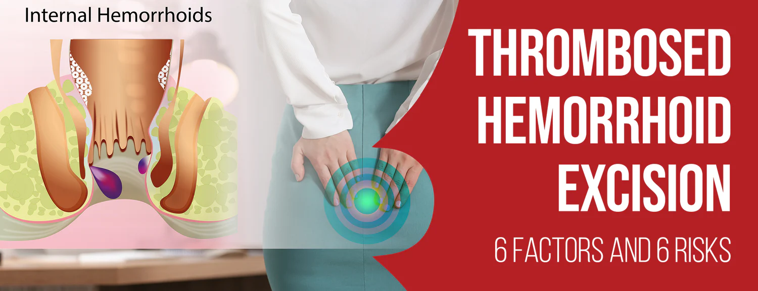 Thrombosed Hemorrhoid Excision: 6 Factors & 6 Risks